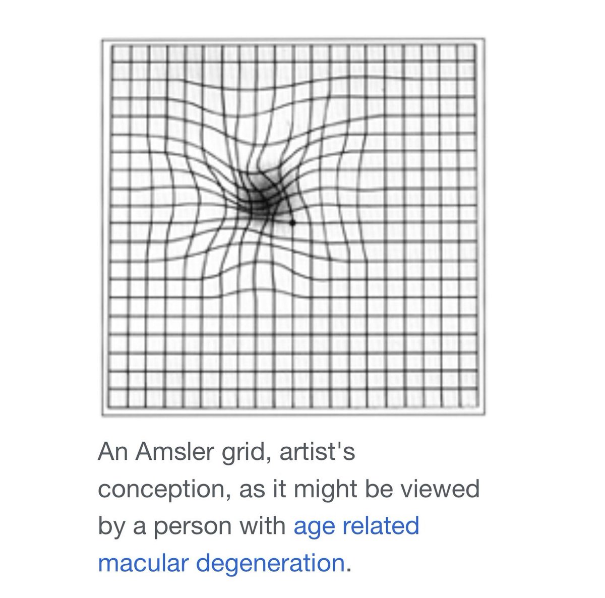 Amsler Grid Macular Degeneration