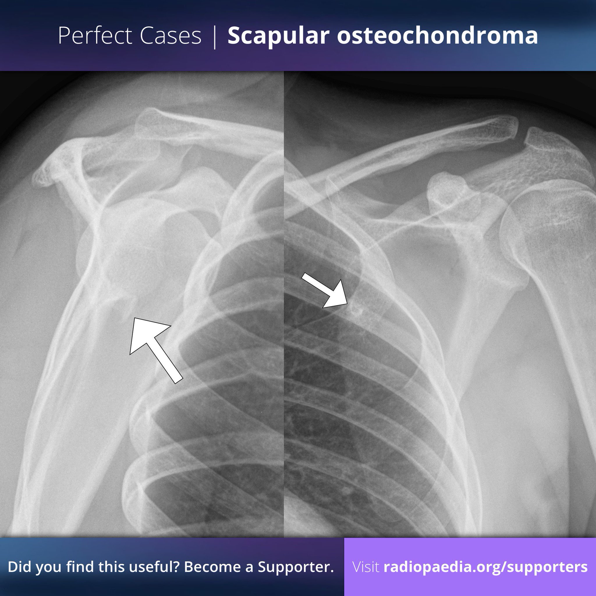 Osteochondroma Radiology