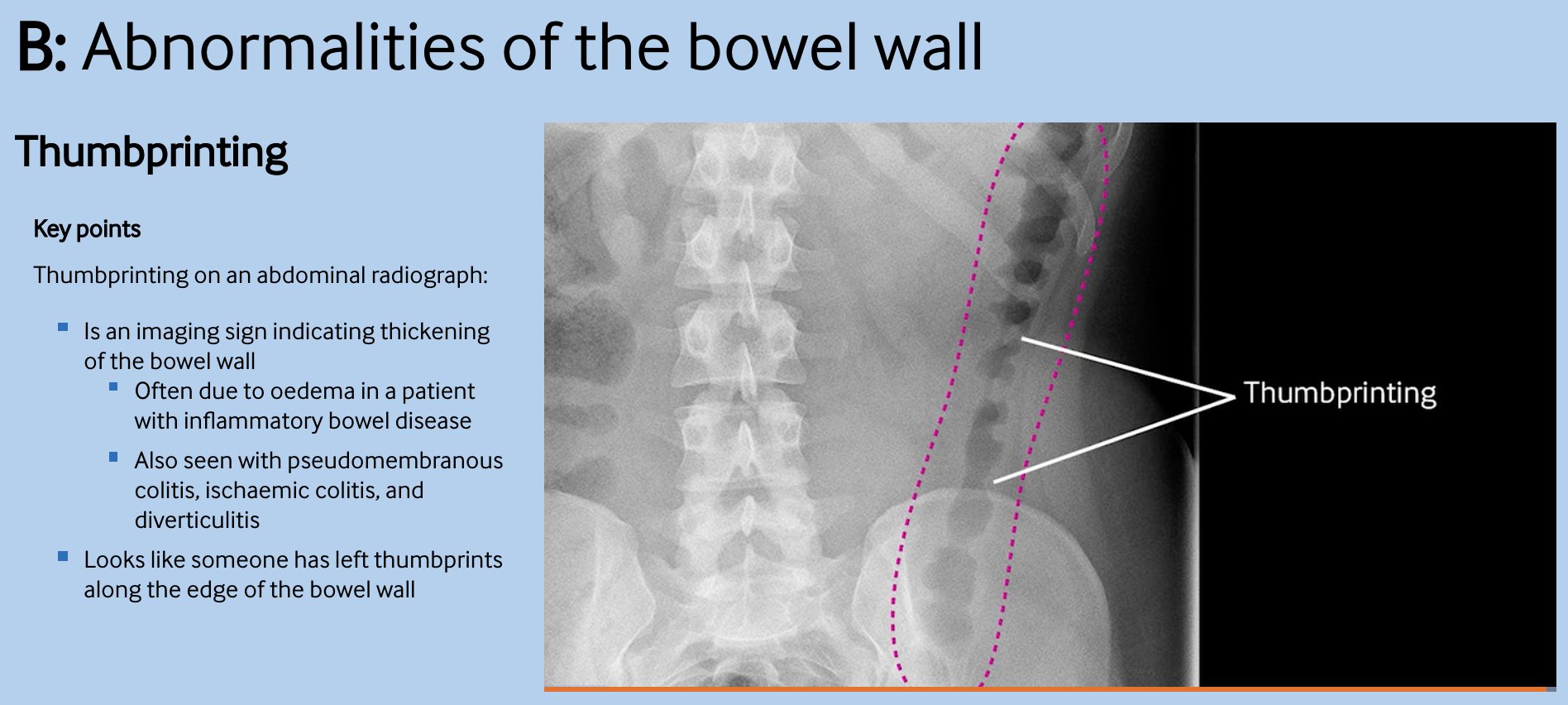 Thumbprint Sign Ischemic Colitis QUICK RADIOLOGY: Thumbprint Sign In