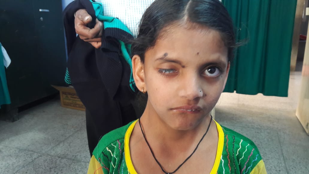 Webbed Neck Turner Syndrome