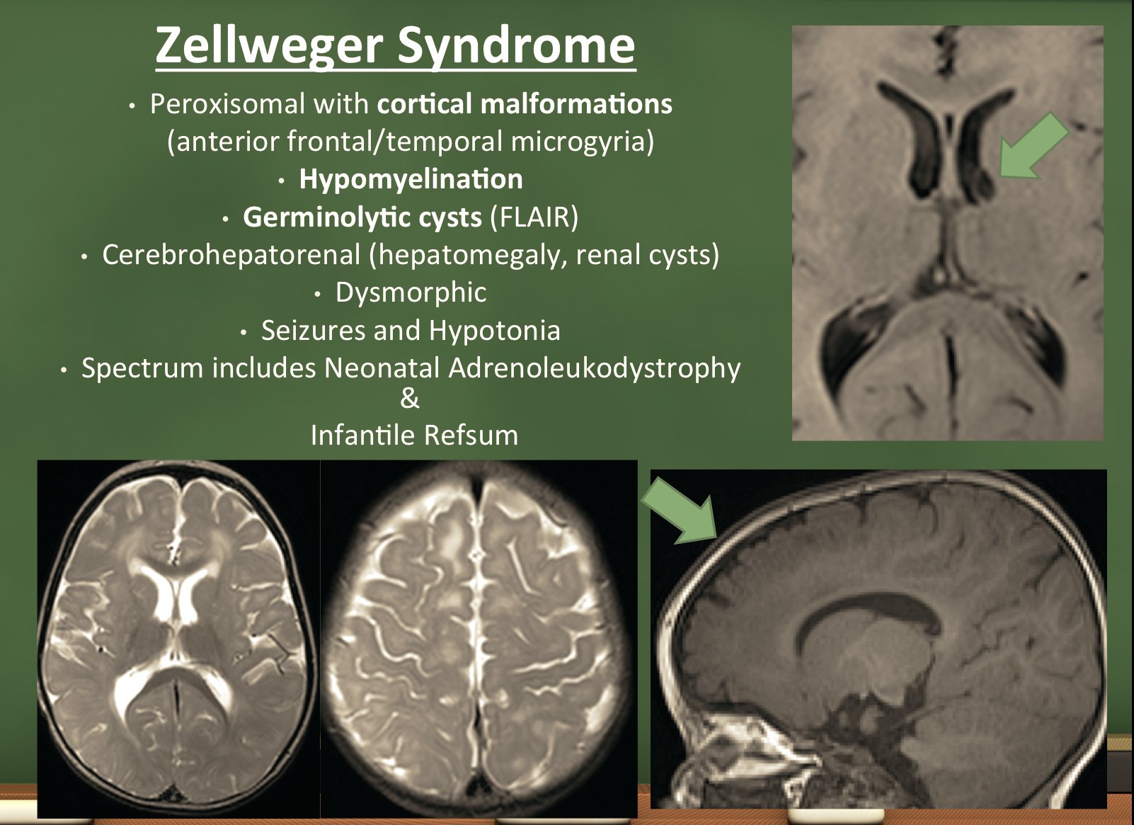 Zellweger Syndrome Peroxisomes