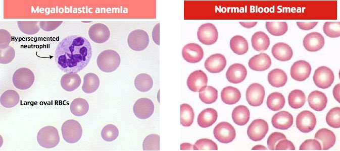 Megaloblastic Anemia Rbc