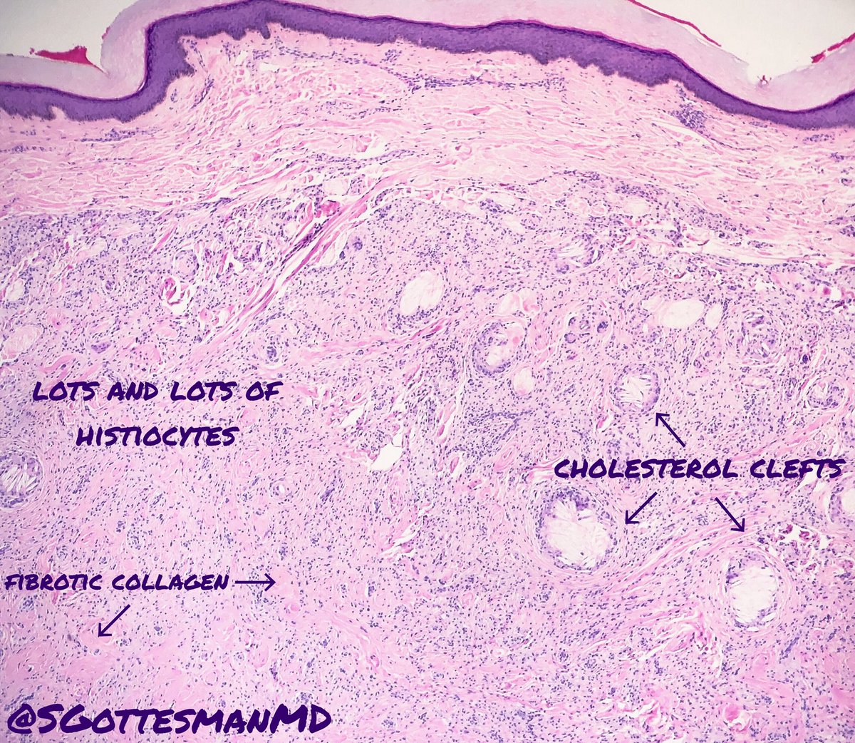 Xanthomas Histology Oral Verruciform Xanthoma: A Series Of 212 Cases