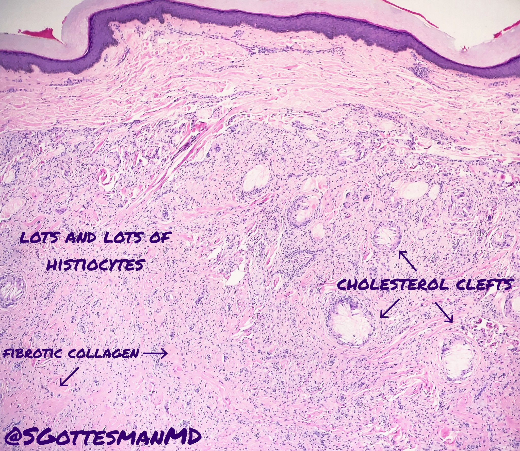 Tendinous Xanthoma Histology