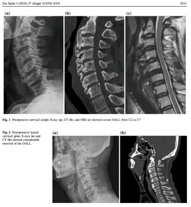 Anterior Longitudinal Ligament Calcification