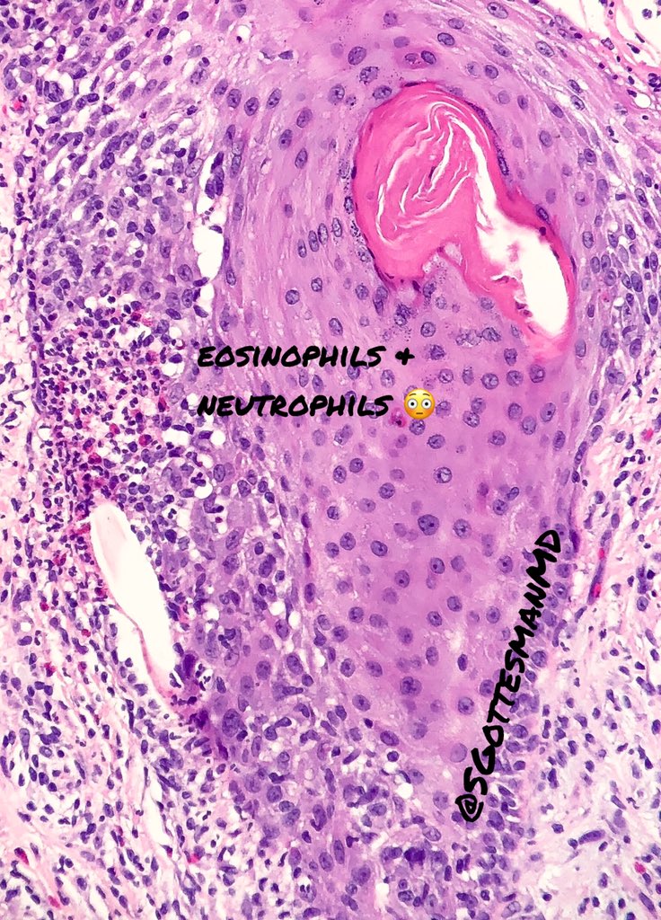 Eosinophilic Pustular Folliculitis Histology