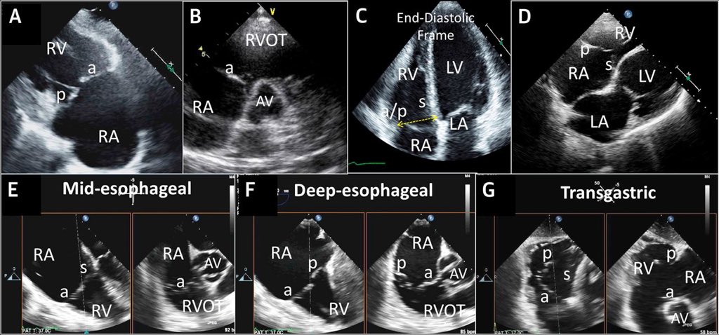 Tricuspid Valve Leaflets