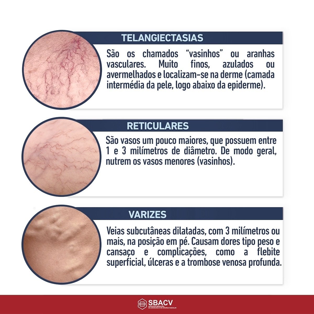Tratamento De Telangiectasias Laser Para Vasinhos E Telangiectasias