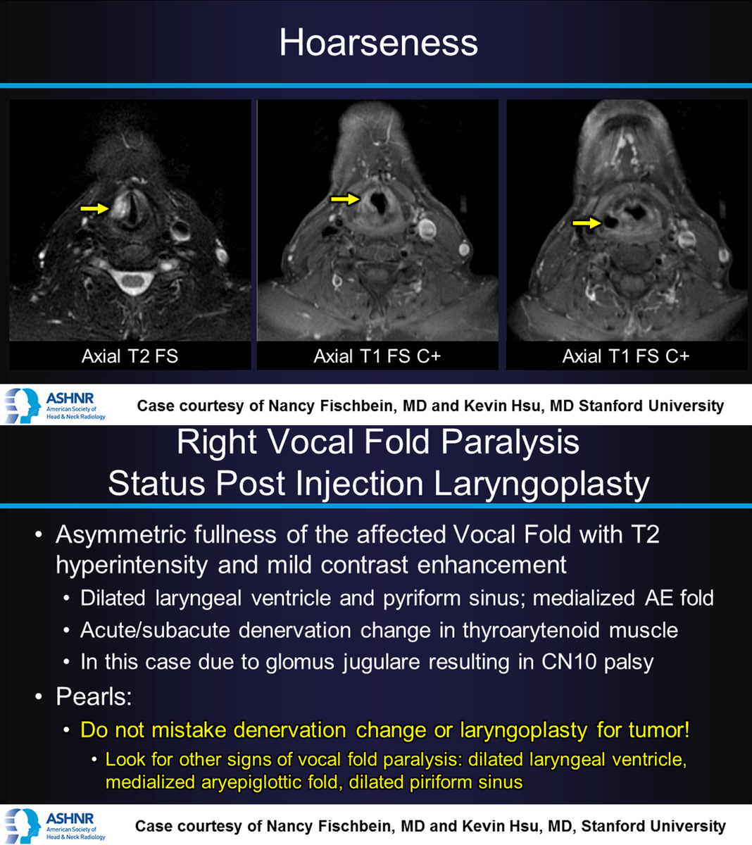 Vocal Cord Paralysis Radiology