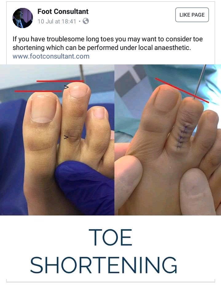 Long Second Toe