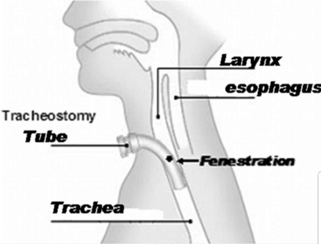 Fenestrated Tracheostomy Tube