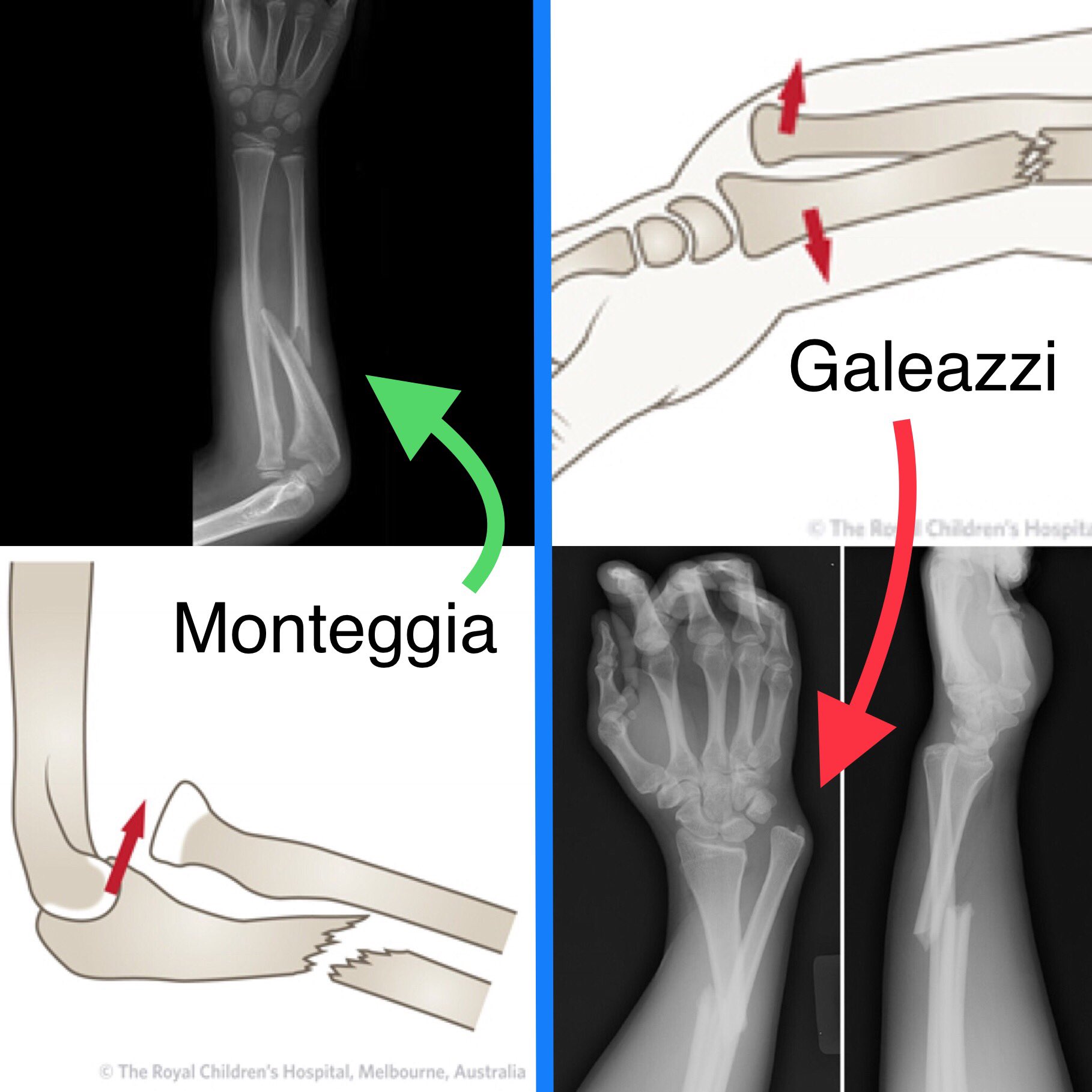Monteggia Y Galeazzi Monteggia Fracture: Practice Essentials, Anatomy,