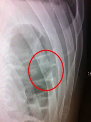X Ray Broken Ribs
