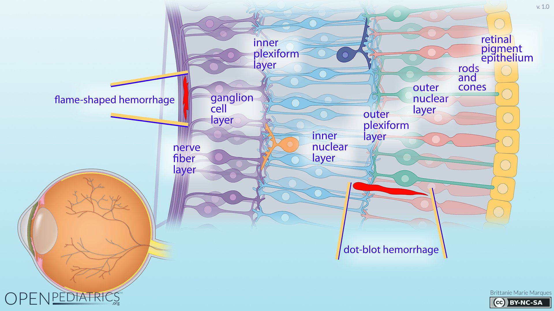 Retinal Flame Hemorrhage