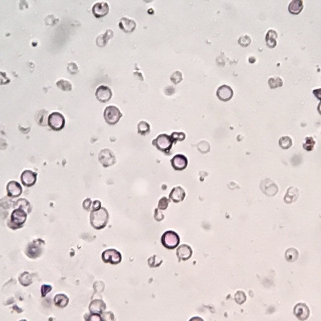 Rbc Cast In Urine