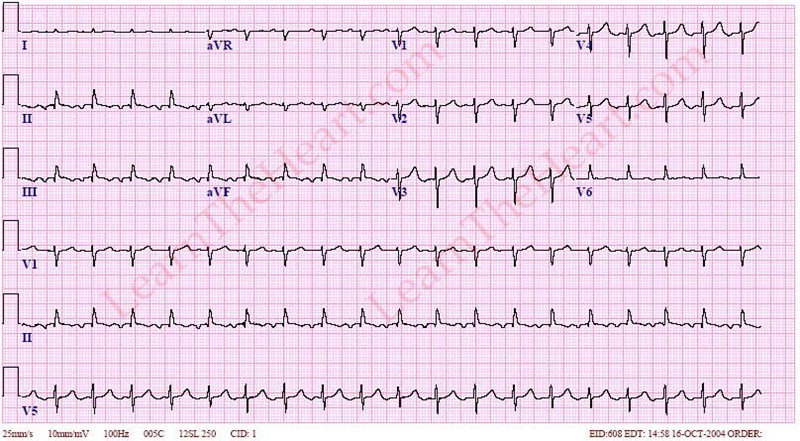 Ectopic Atrial Tachycardia Ecg
