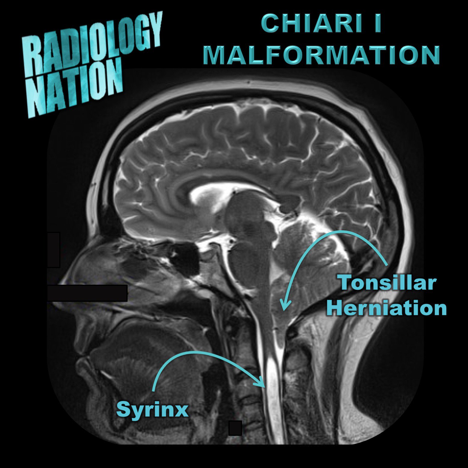 Tonsillar Herniation Radiology