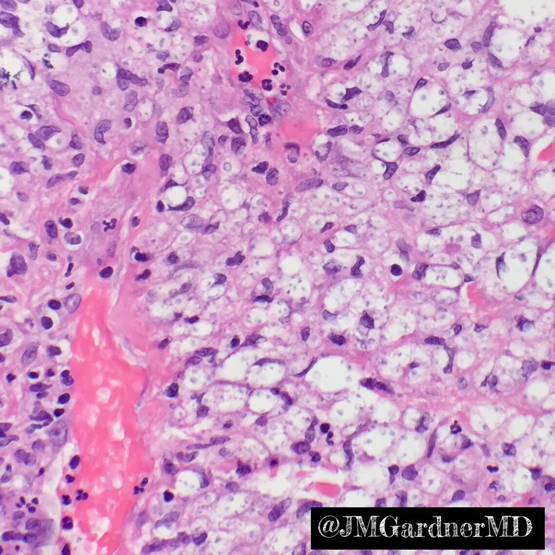 Cryptococcus Histology