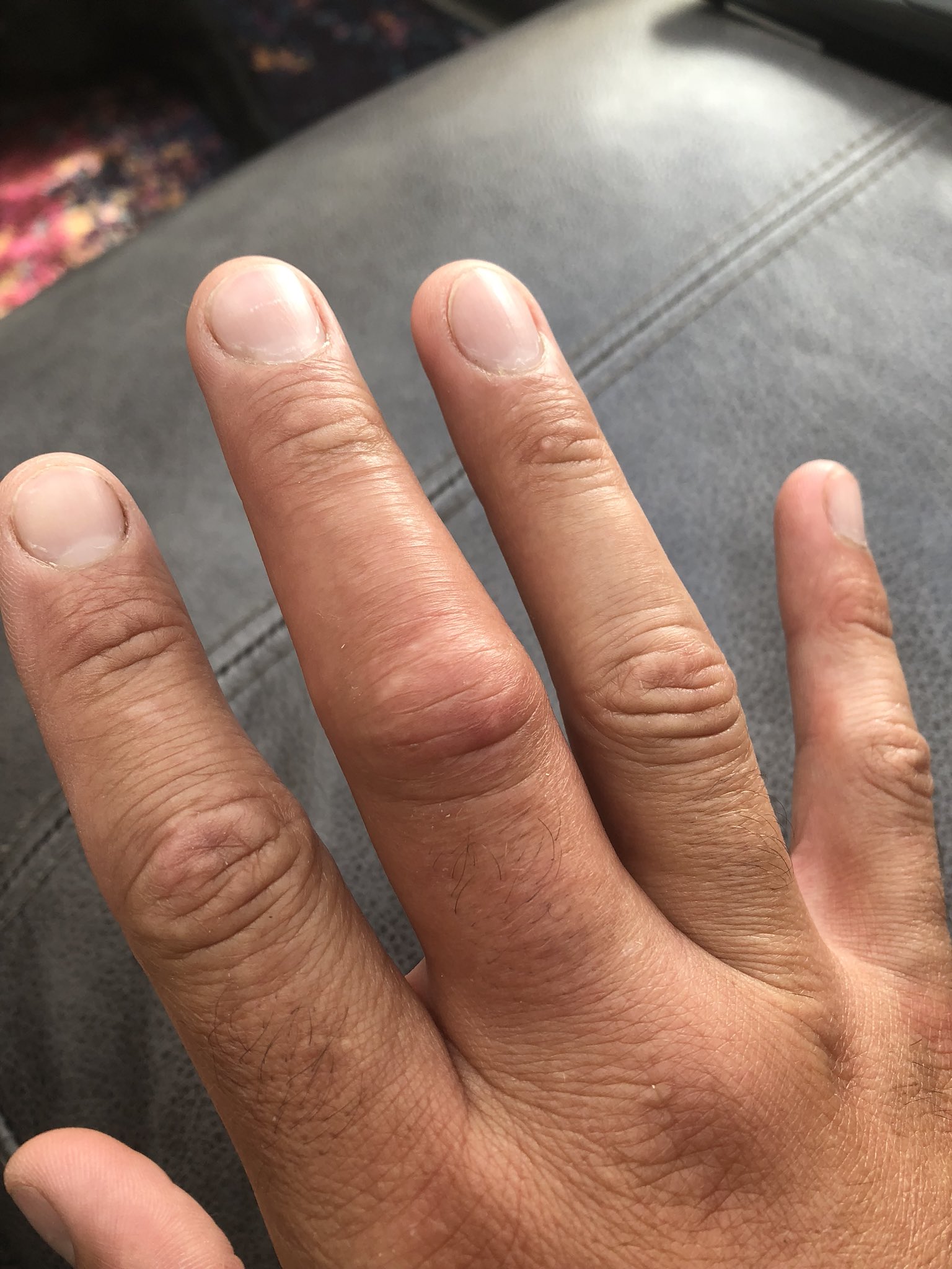 Wasp Sting On Finger Kadannal' Or Wasp Attack: Precautions, Remedies