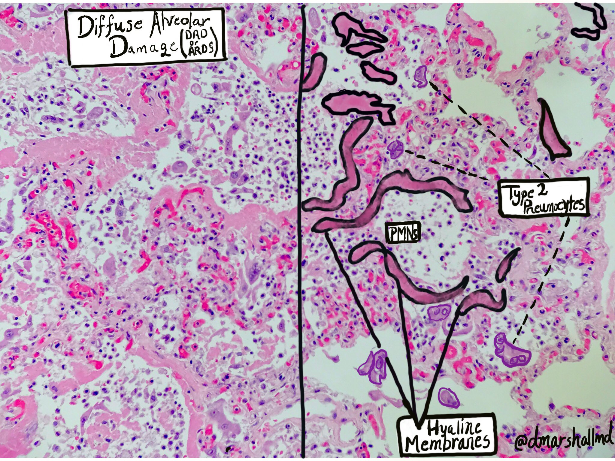Respiratory Distress Syndrome Histology