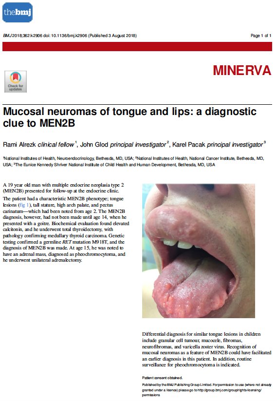 Mucosal Neuroma Men2b