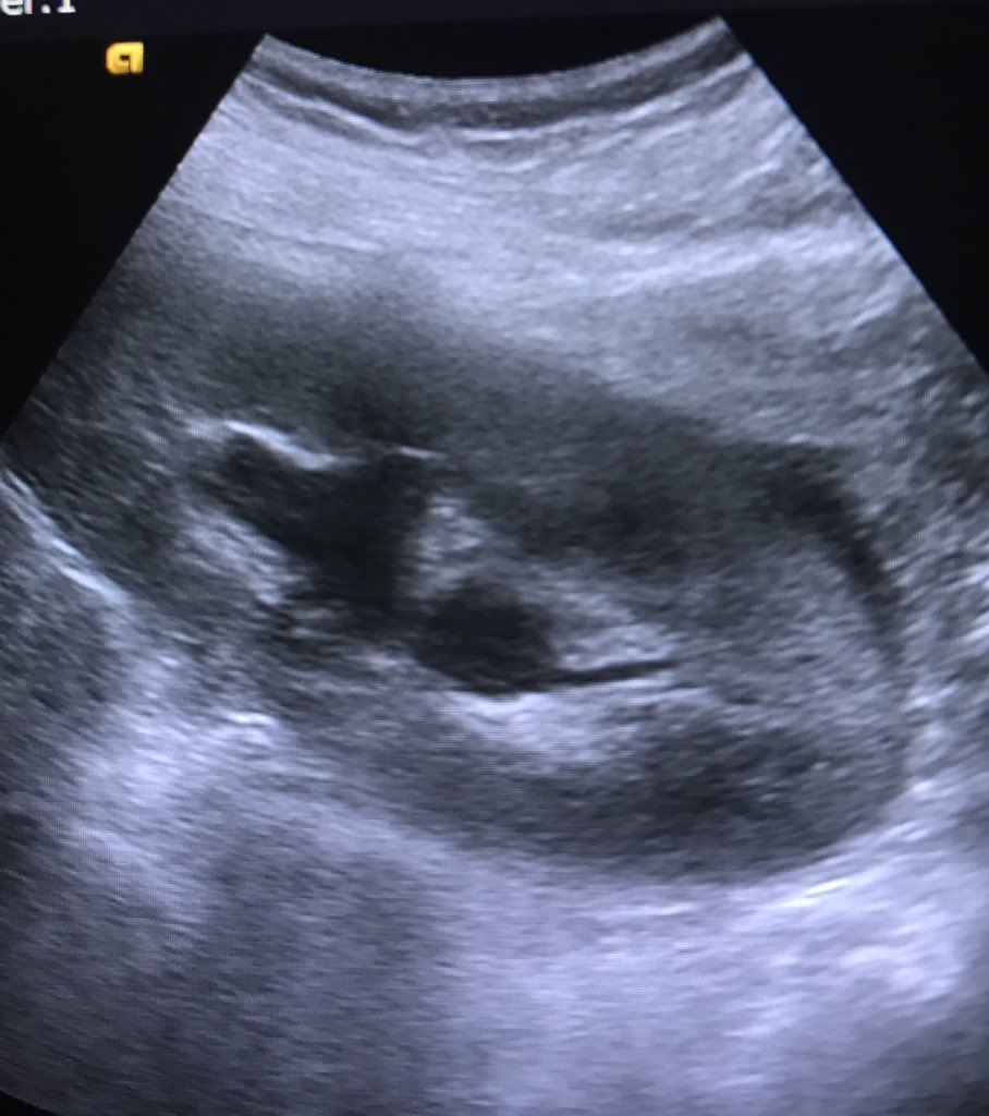 Nephrostomy Tube Ultrasound