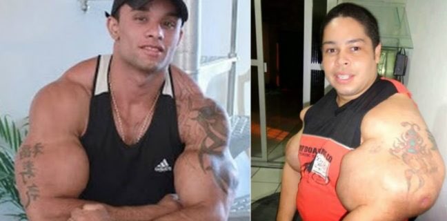 Synthol Before After
