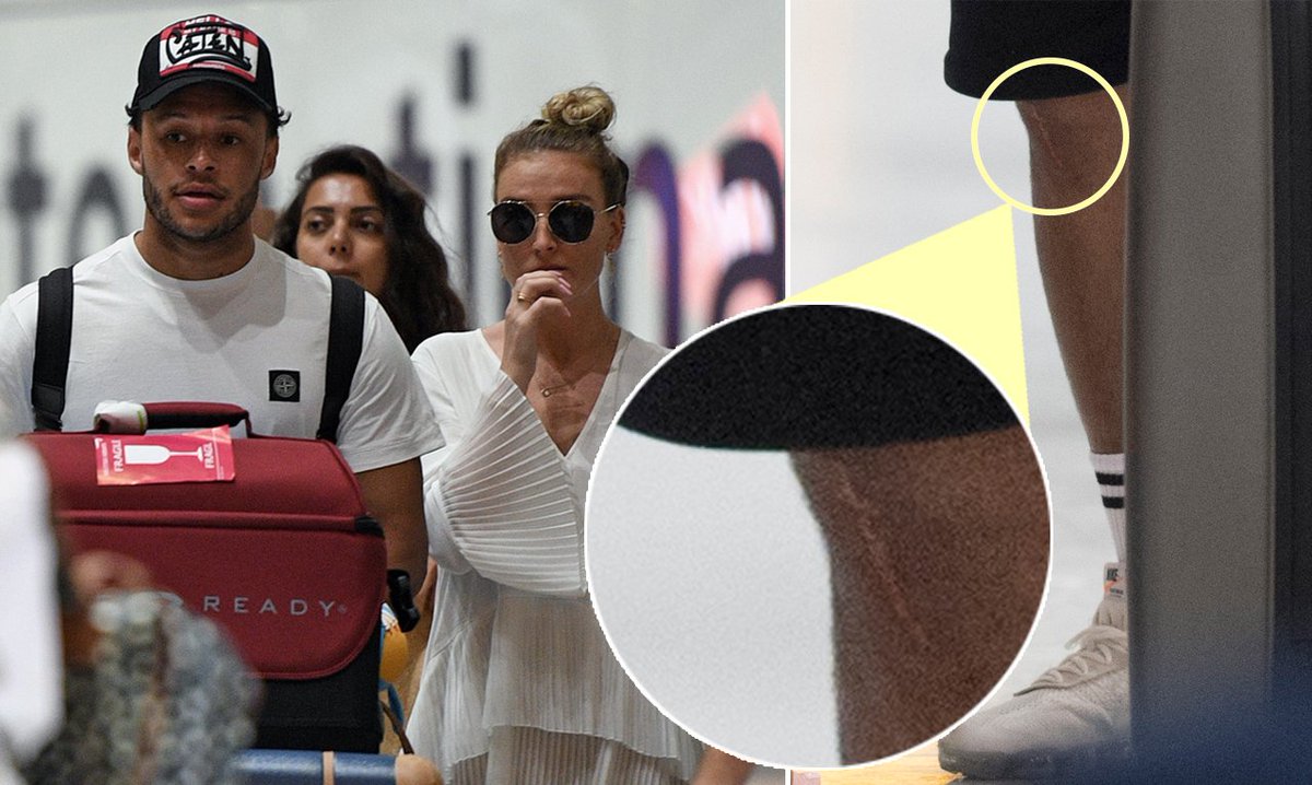 Perrie Edwards Scar