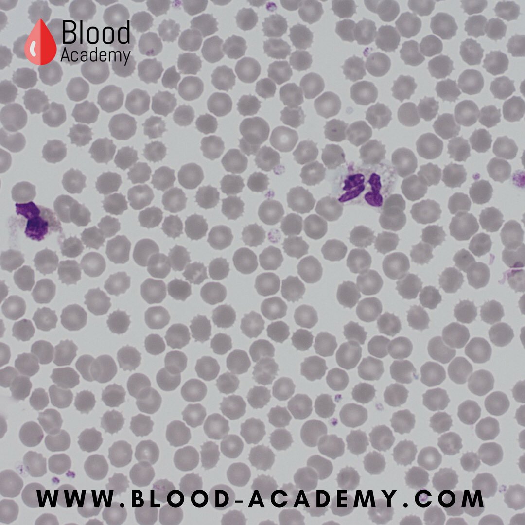 Echinocytes And Crenation