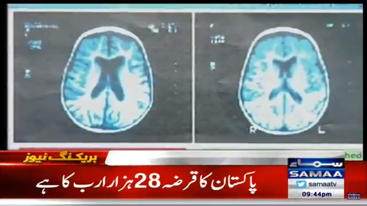 Brain Tumor Causes In Urdu