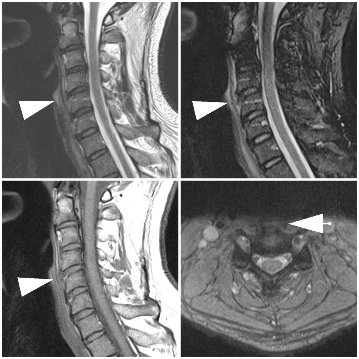 Sagittal T2 Weighted Image A Shows Normal Anterior Download