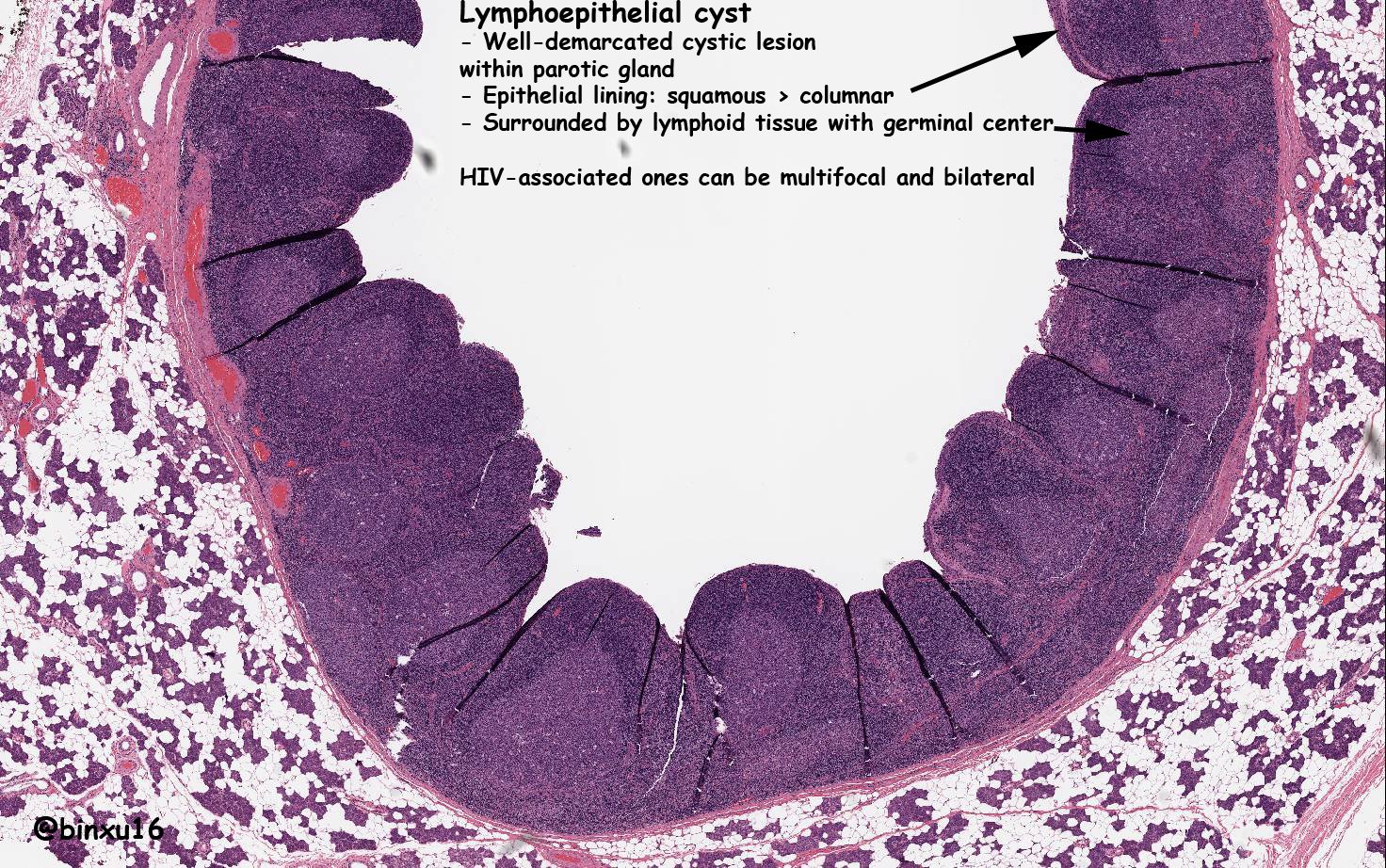Lymphoepithelial Cysts