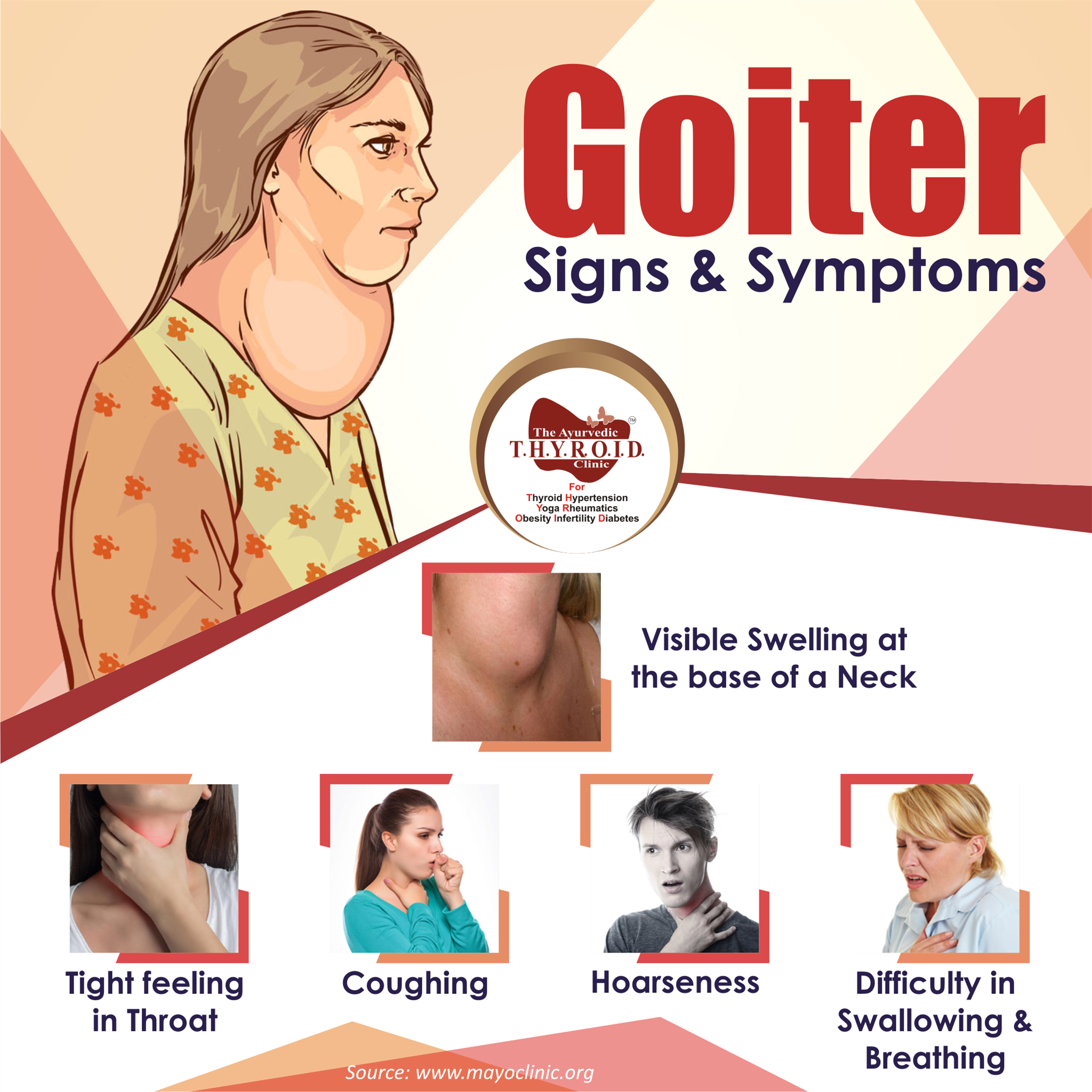 Swollen Thyroid Gland Symptoms