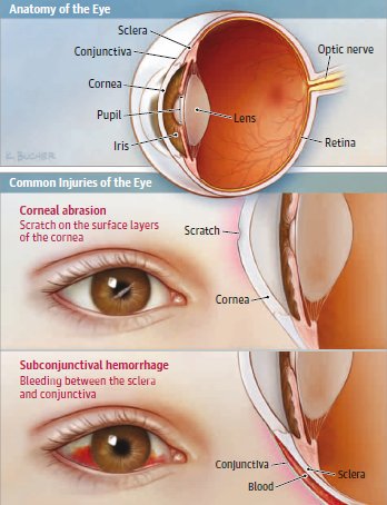 Scratched Sclera