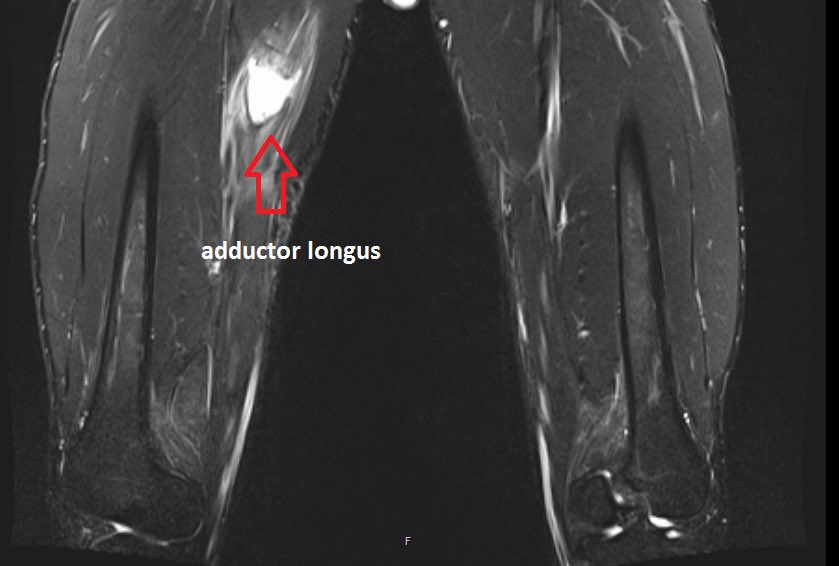 Adductor Muscles Mri
