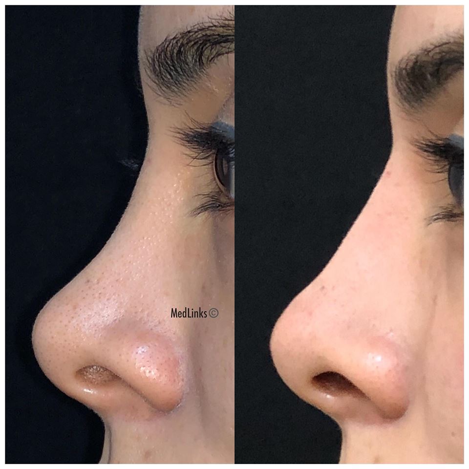 Most Beautiful Nose Profile