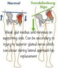 Superior Gluteal Nerve Injury