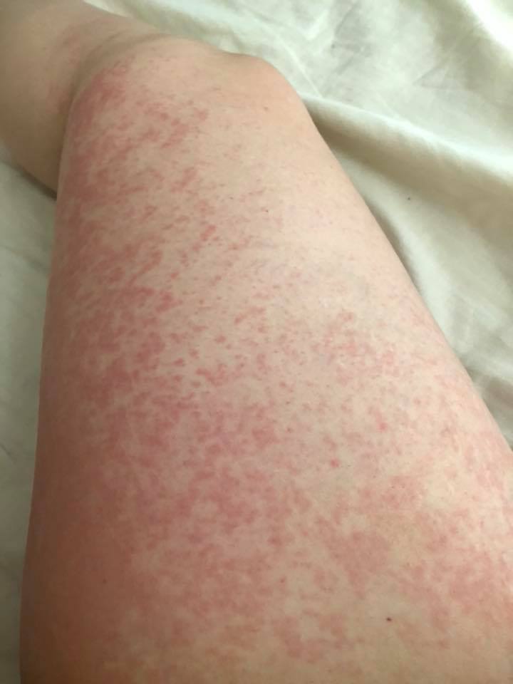 Sepsis Rash