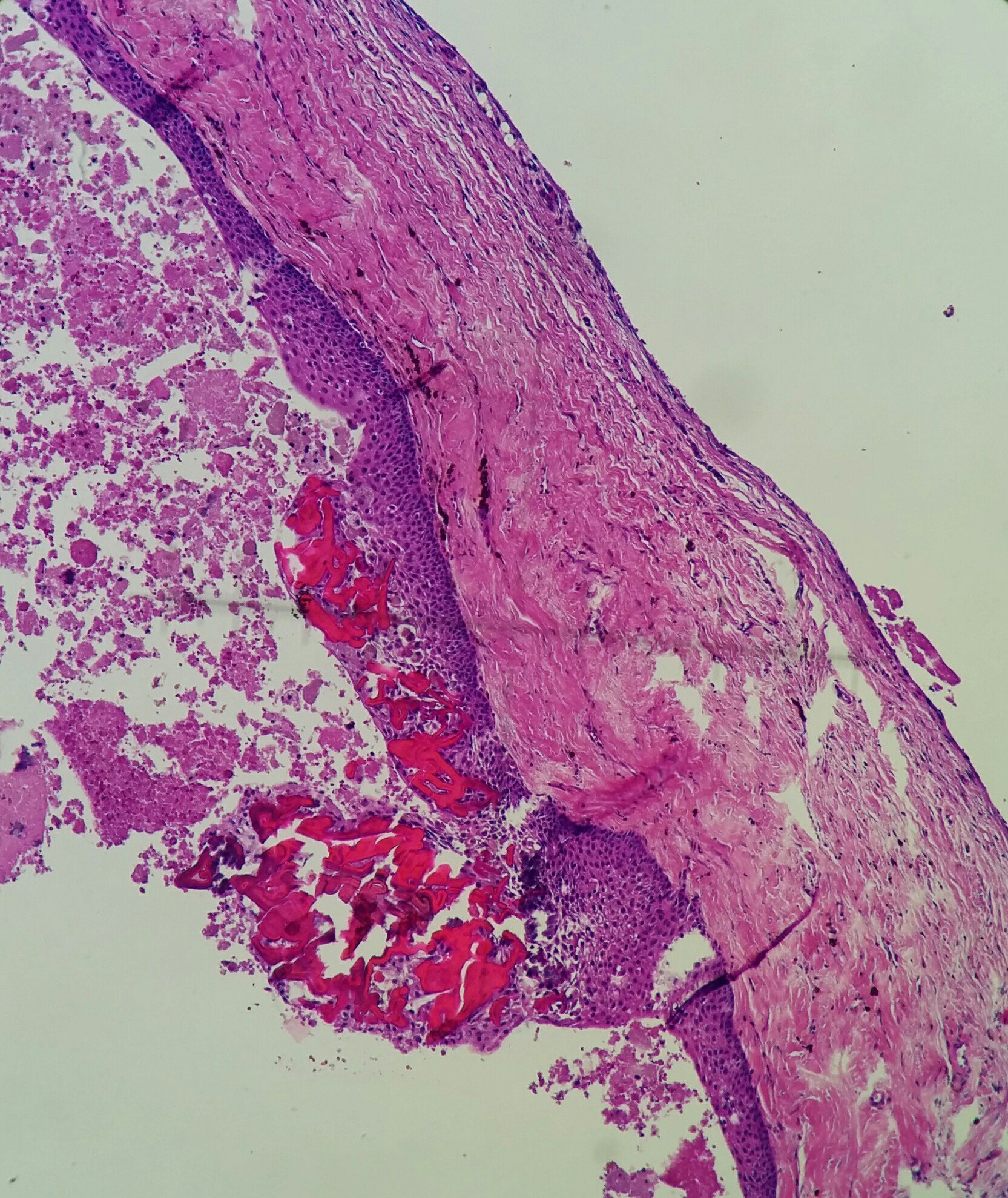 Radicular Cyst Histology