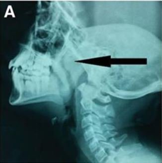 Adenoid Hypertrophy X Ray