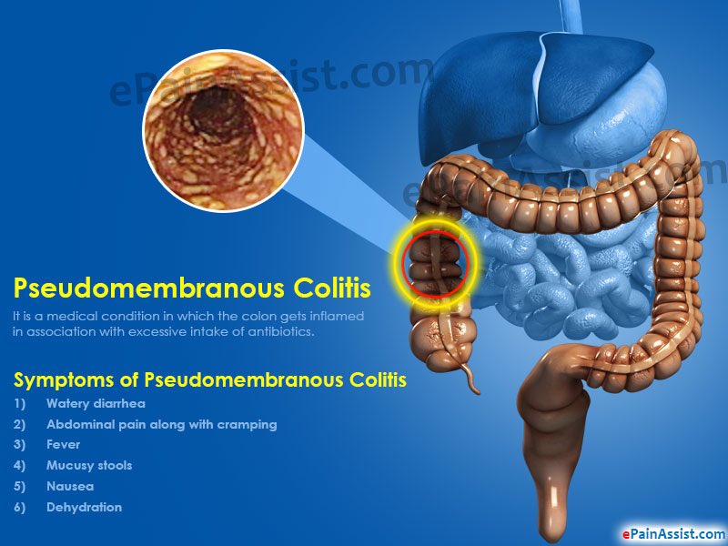 Pseudomembranous Colitis Stool