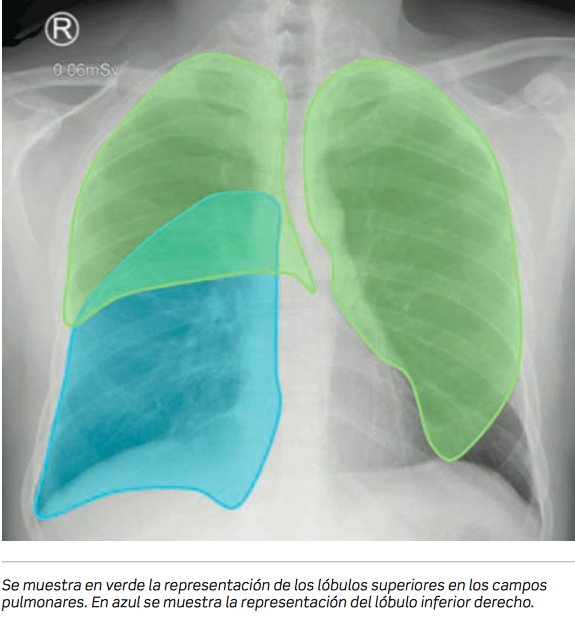 Lóbulos Pulmonares