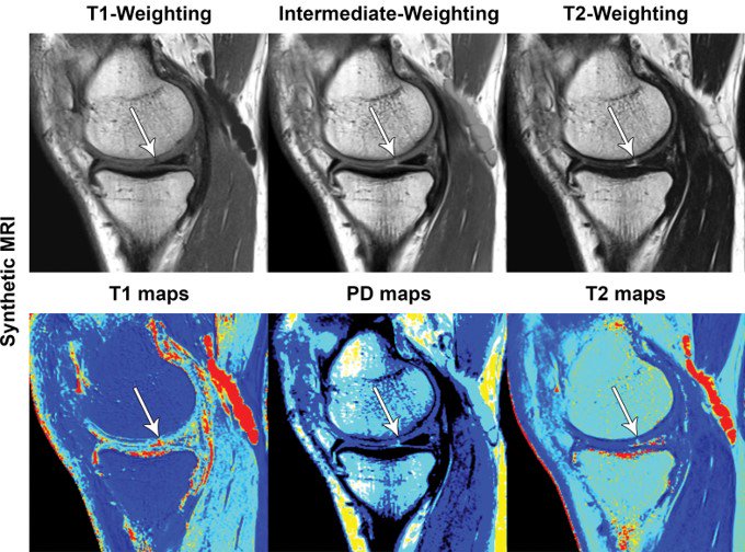 T2 Mri Of The Knee