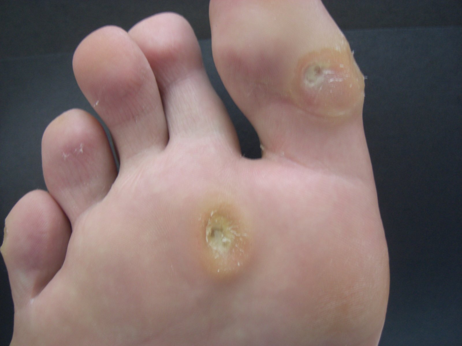 Hole In Callus On Bottom Of Foot Outlet | emergencydentistry.com
