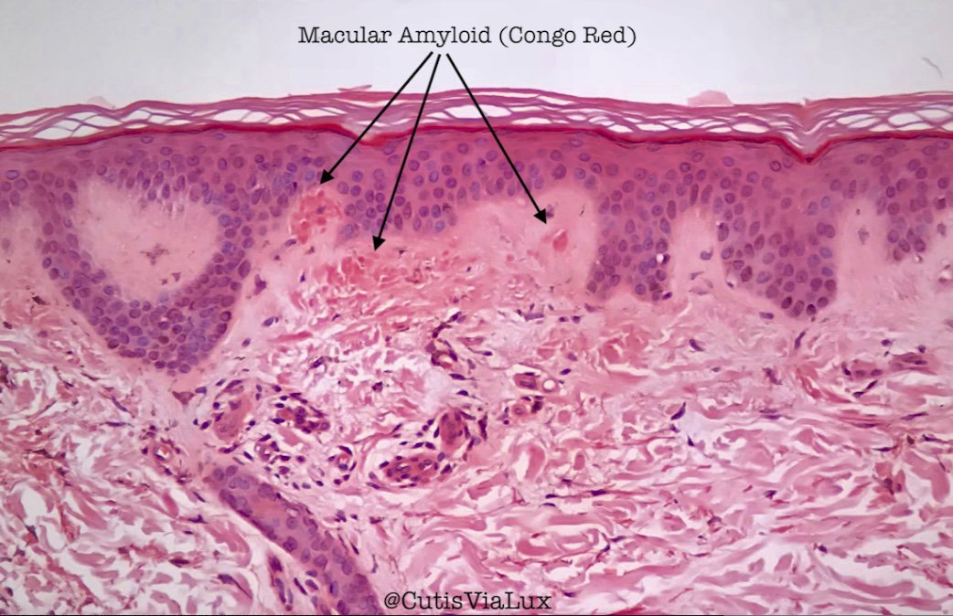 Lichen Amyloidosis Histopathology