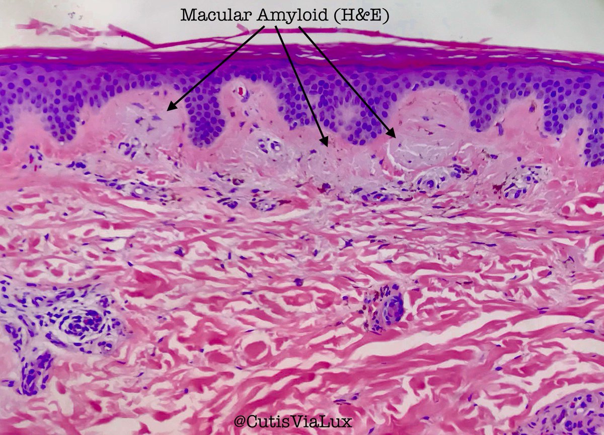 Lichen Amyloidosis Histopathology Anogenital Lichenoid Lesions: