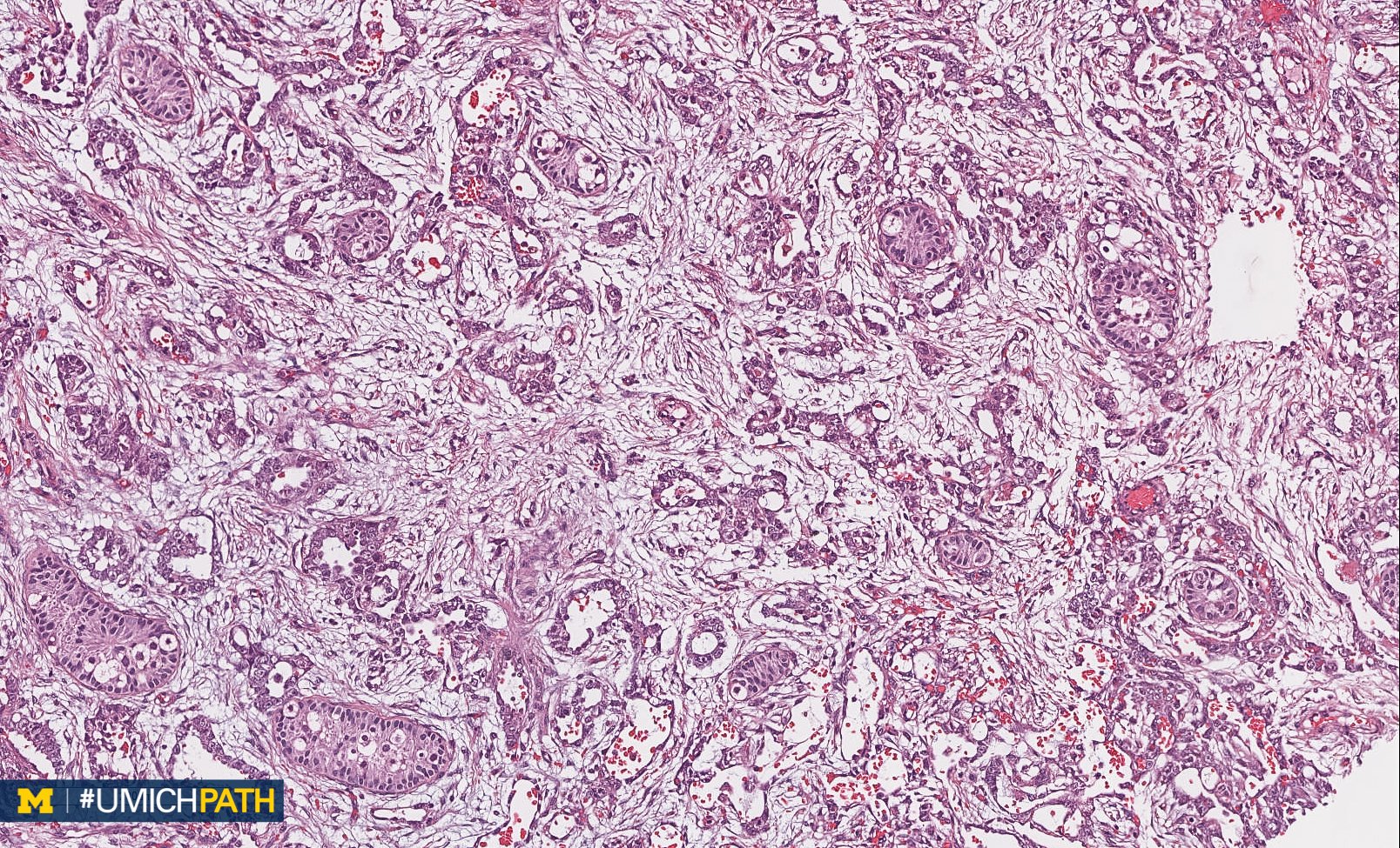 Yolk Sac Tumor Schiller Duval Bodies