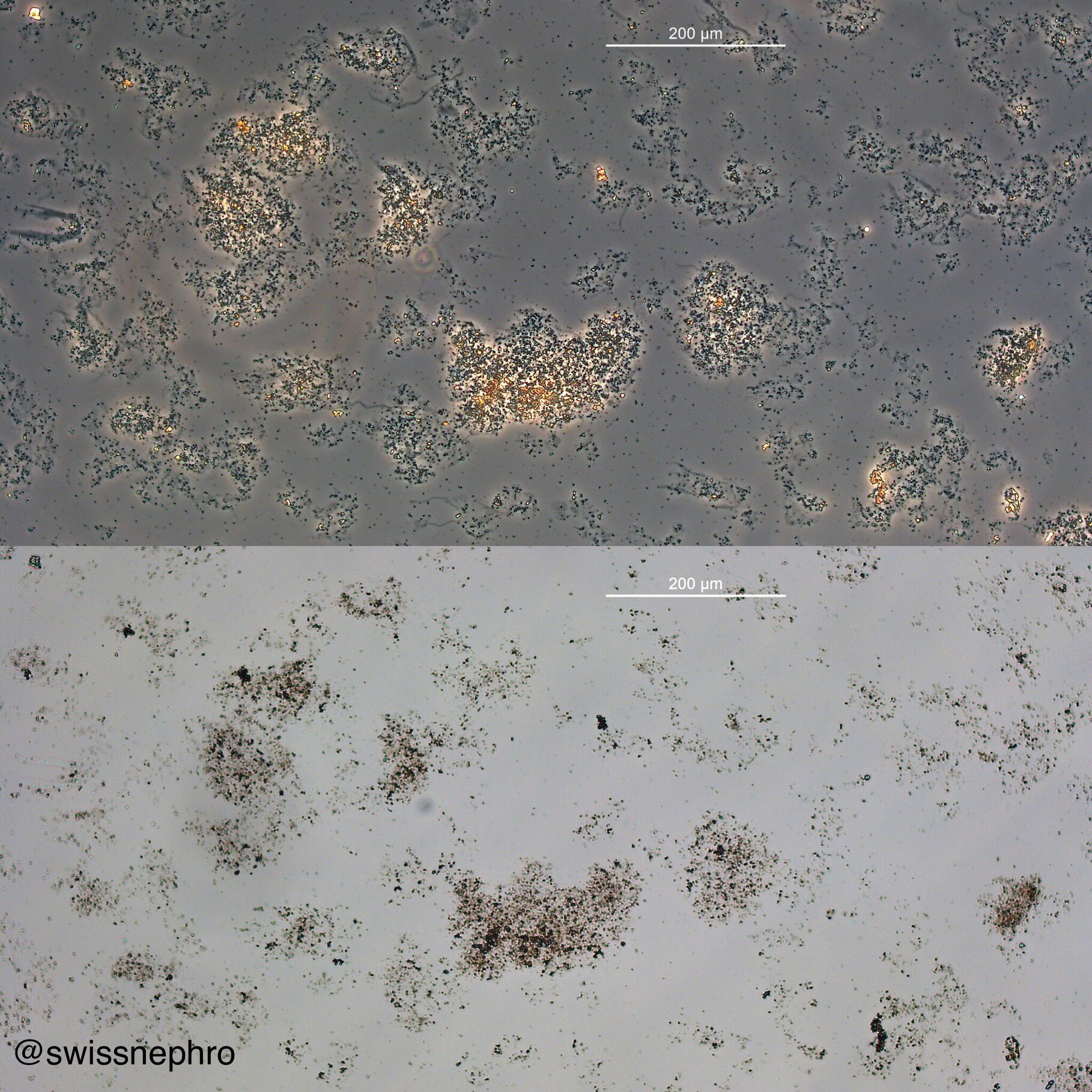 Amorphous Urates In Urine