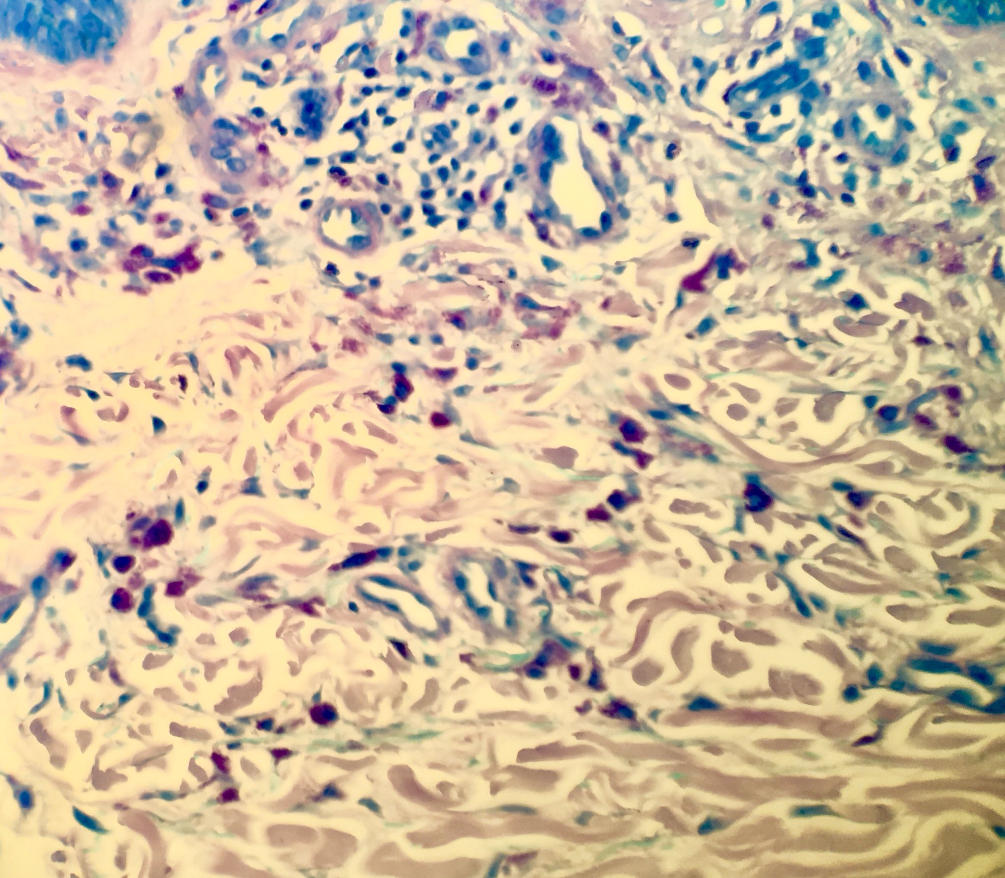 Telangiectasia Macularis Eruptiva Perstans Histology