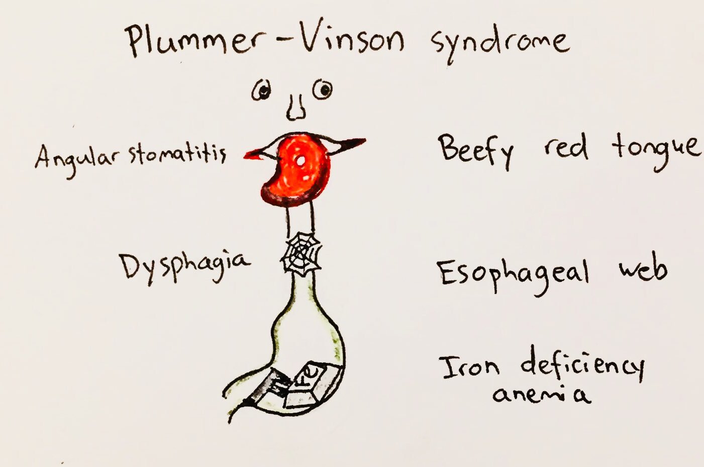 Plummer Vinson Syndrome